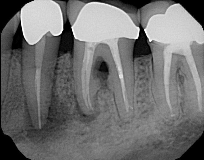 Septic Tank Teeth (abridged) - IABDM
