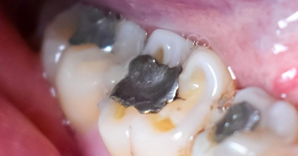 Amalgam Fillings - IABDM